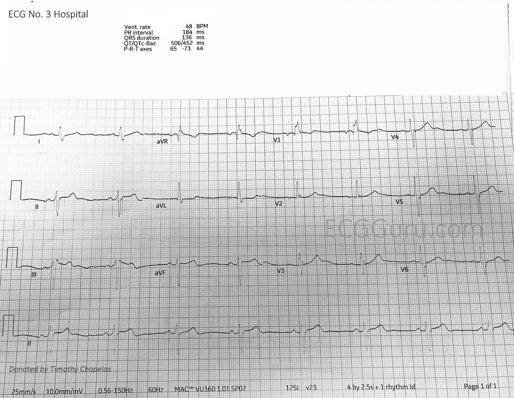 Inferior Myocardial Infarction Ecg